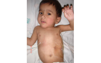 Schedule a Pediatric Urodynamics Procedure| Urodynamic Test
